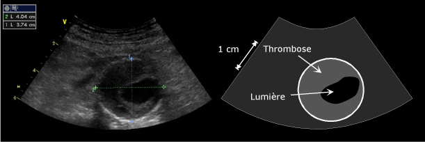 3A - Etat de la paroi artérielle - Ultrasonographie - Echographie - Doppler